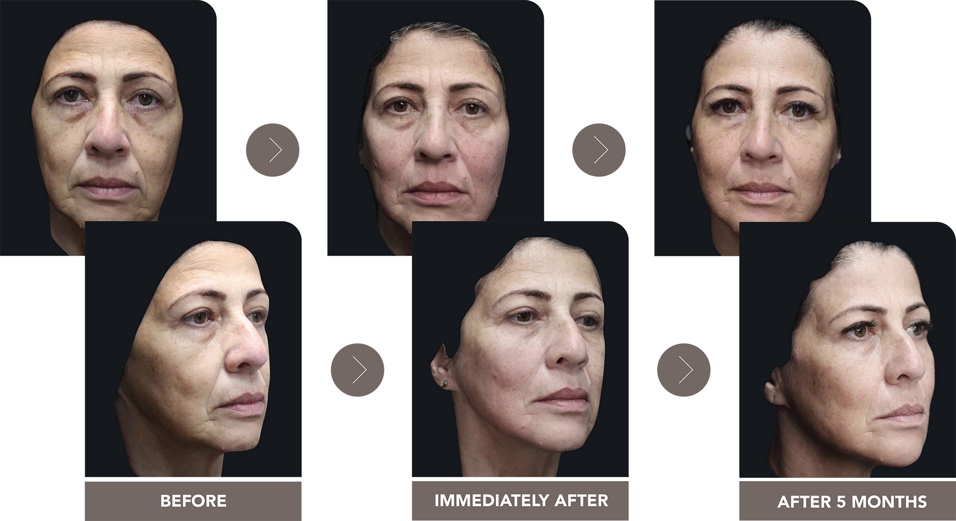 HArmonyCA™ is a dual-effect collagen stimulating hybrid Injectable